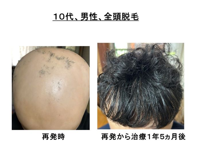 患者さんのお母様の声”息子は、髪をくしでとくようになりました！” 患者様からの声・メディア掲載・クリニックからのお知らせ 名古屋kクリニック